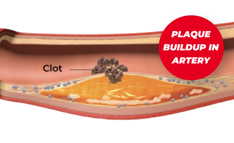 What is Bad Cholesterol (LDL-C)?