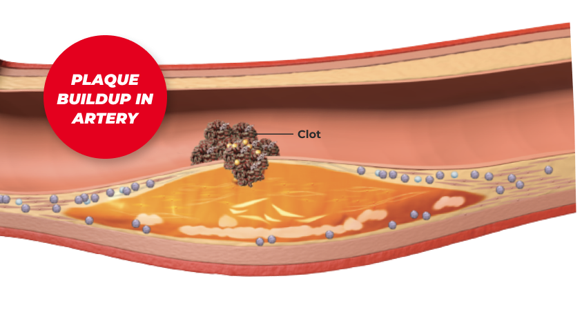 What is Bad Cholesterol (LDL-C)?
