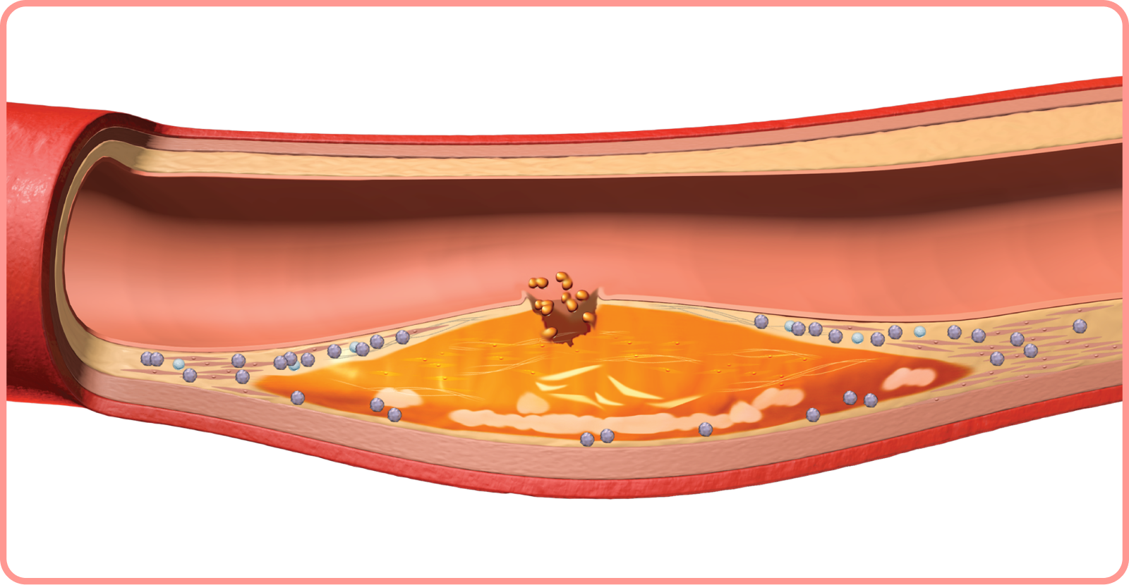 Atherosclerosis and Plaque Vulnerability | Attack Heart Disease HCP