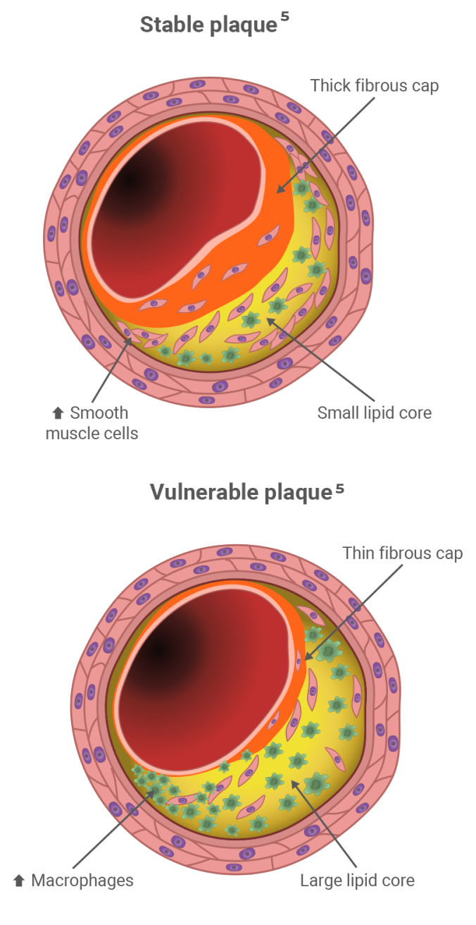 Plaque Burden and Vulnerability